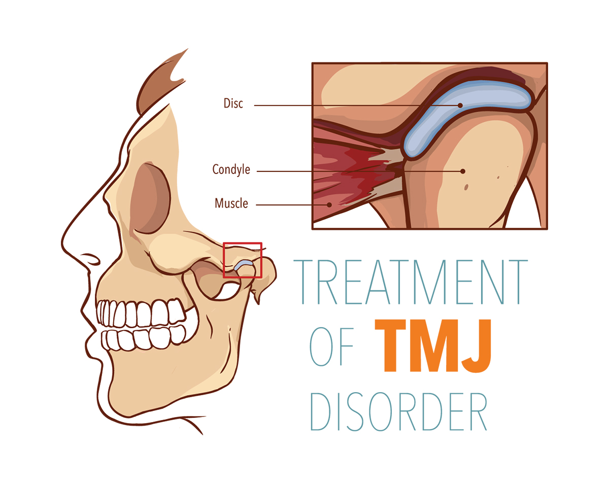 Temporomandibular Disorder - Arasu Dental Care
